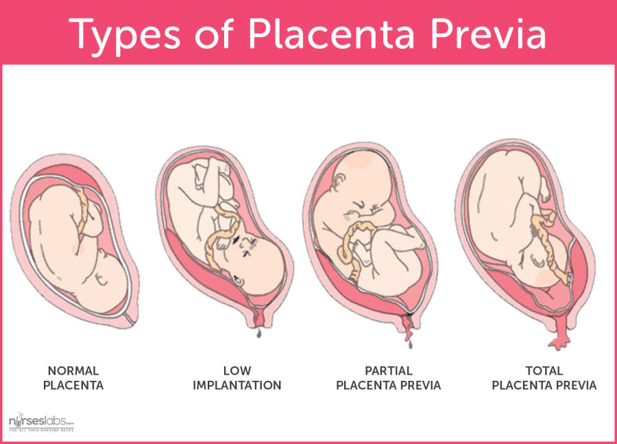 Placenta Pr via O Que Causas Sintomas E Tratamento